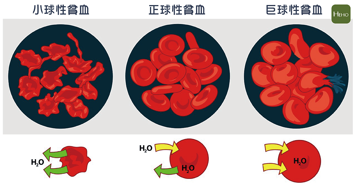 貧血不是吃鐵就好,紅血球還可能出這幾種狀況! Heho健康